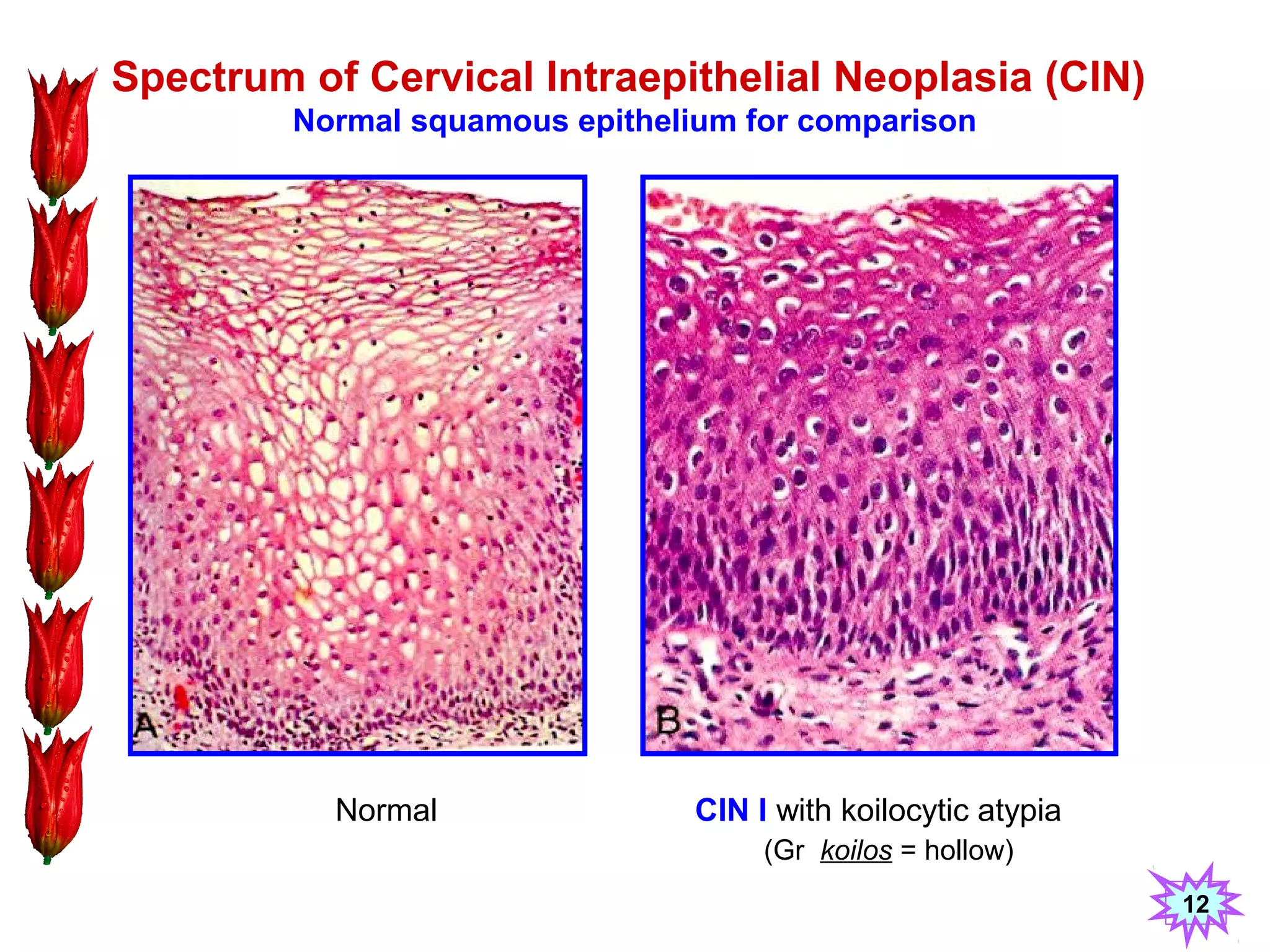 Neoplasia, two | PPT