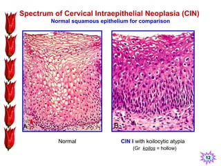 Neoplasia, two | PPT