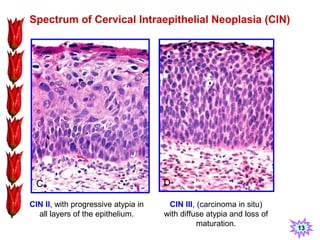 Neoplasia, two | PPT