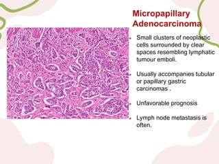 neoplasm of stomach 5th edition of who classification by Dr Yogeeta ...