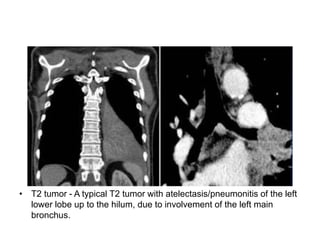Neoplasms of Lung.pptx