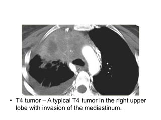 Neoplasms of Lung.pptx