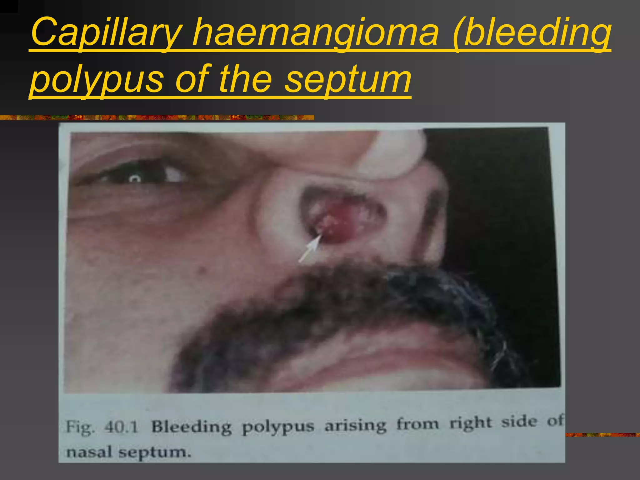 Neoplasms of nasal cavity and nasal polypi | PPT