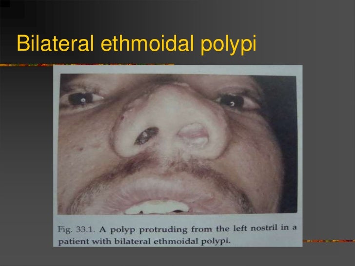 Neoplasms of nasal cavity and nasal polypi