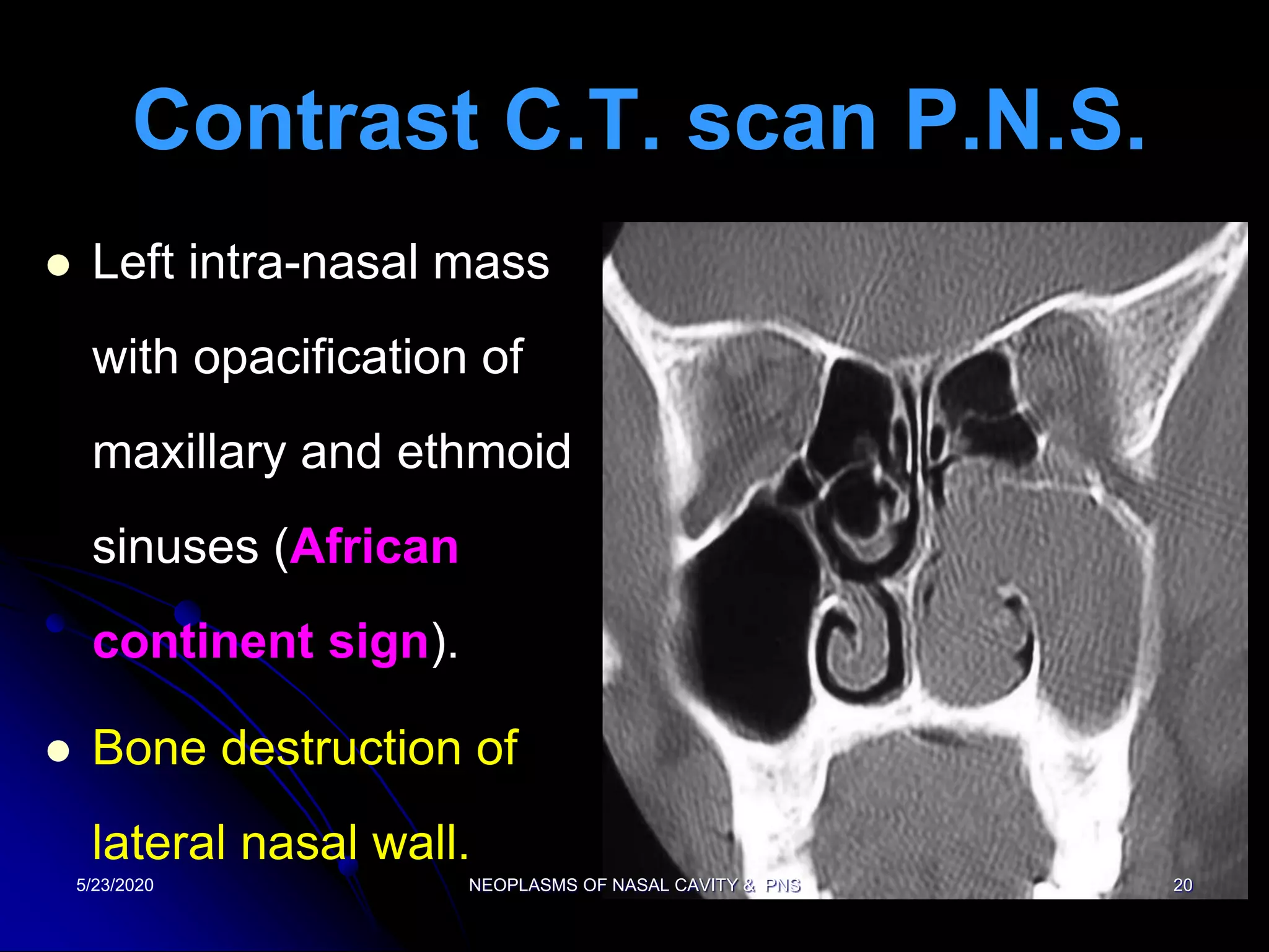 Neoplasms of nose and paranasal sinuses | PPTX