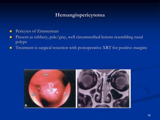 Neoplasms of nose and para nasal sinuses.ppt