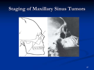 Neoplasms of nose and para nasal sinuses.ppt
