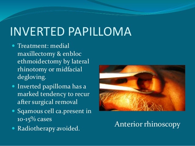 Neoplasms of nose and pns