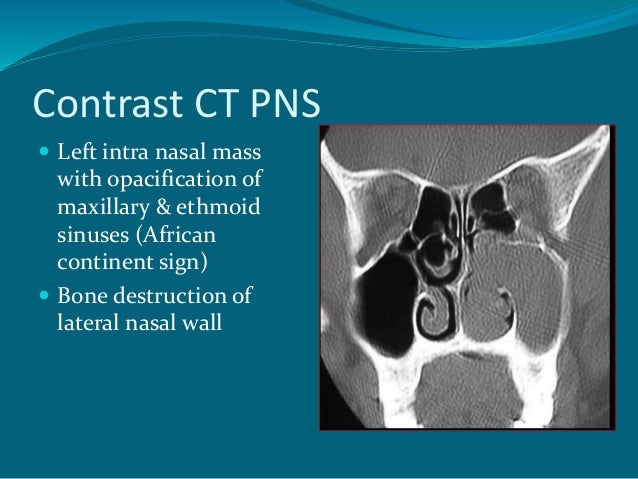 Pns Ct Anatomy