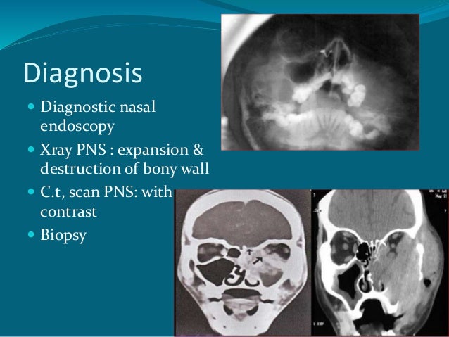 Neoplasms of nose and pns