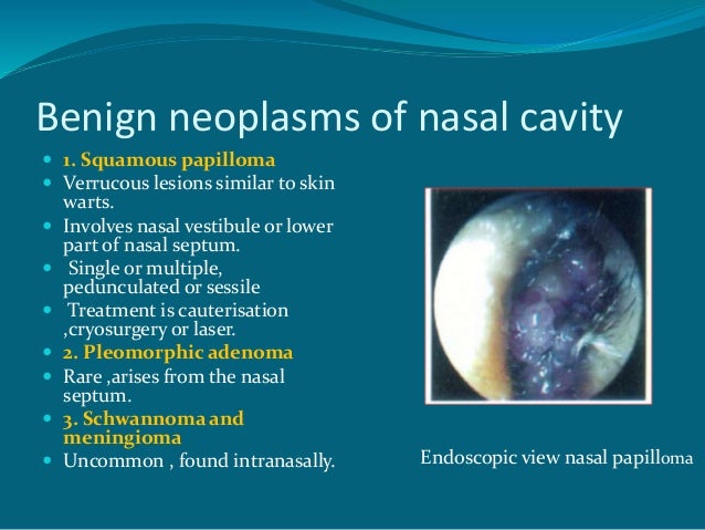 Neoplasms of nose and pns