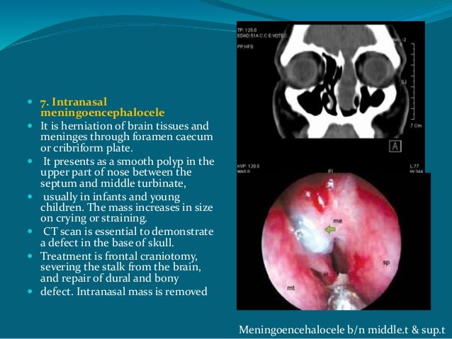 Neoplasms of nose and pns