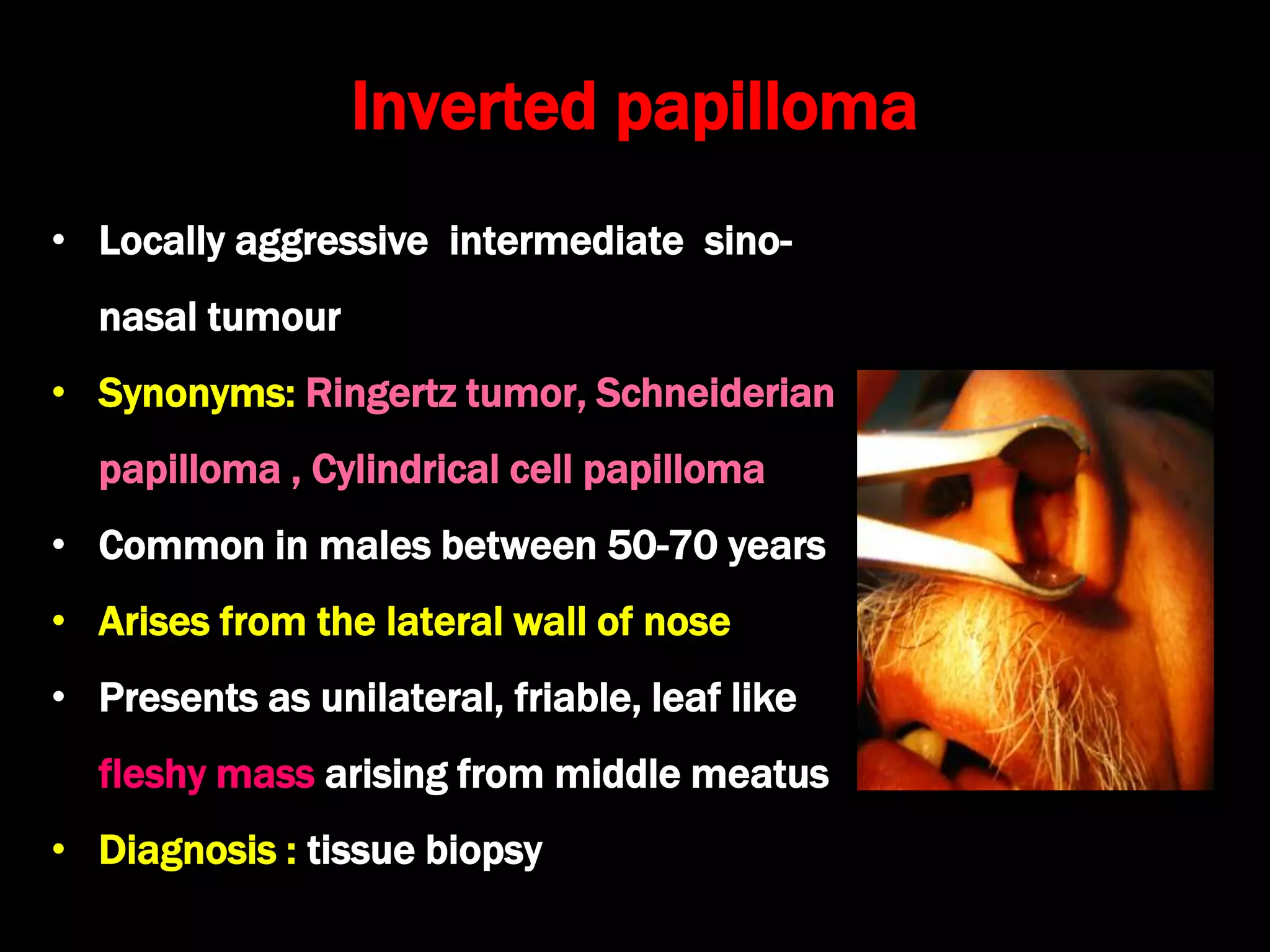 Neoplasms of nose and paranasal sinuses | PPT
