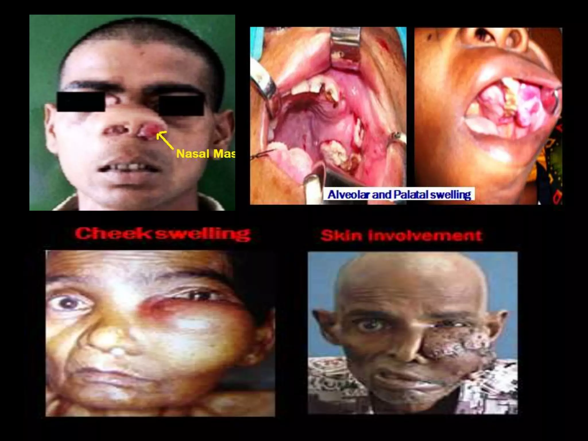 Neoplasms of nose and paranasal sinuses | PPT