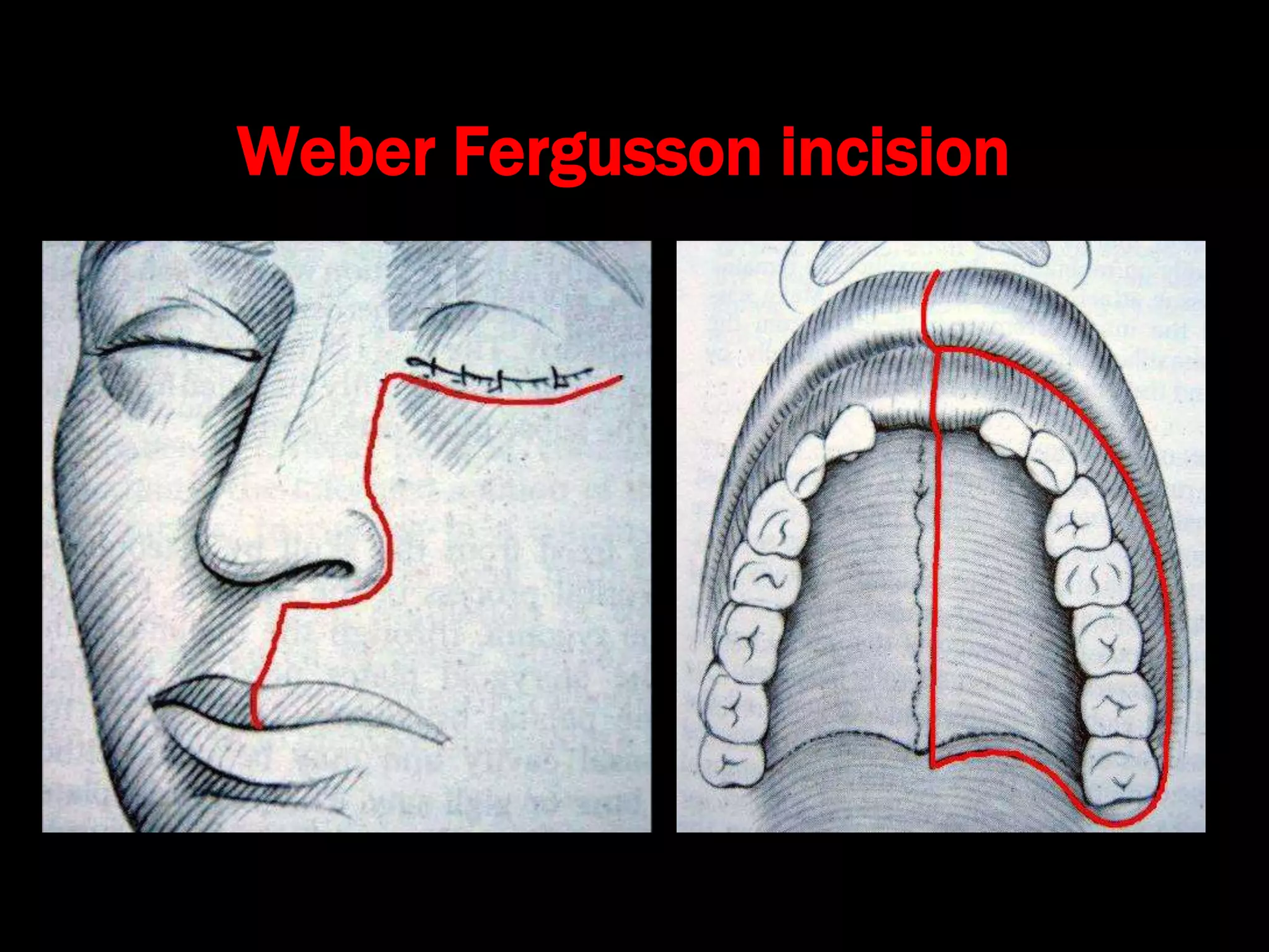 Neoplasms of nose and paranasal sinuses | PPT
