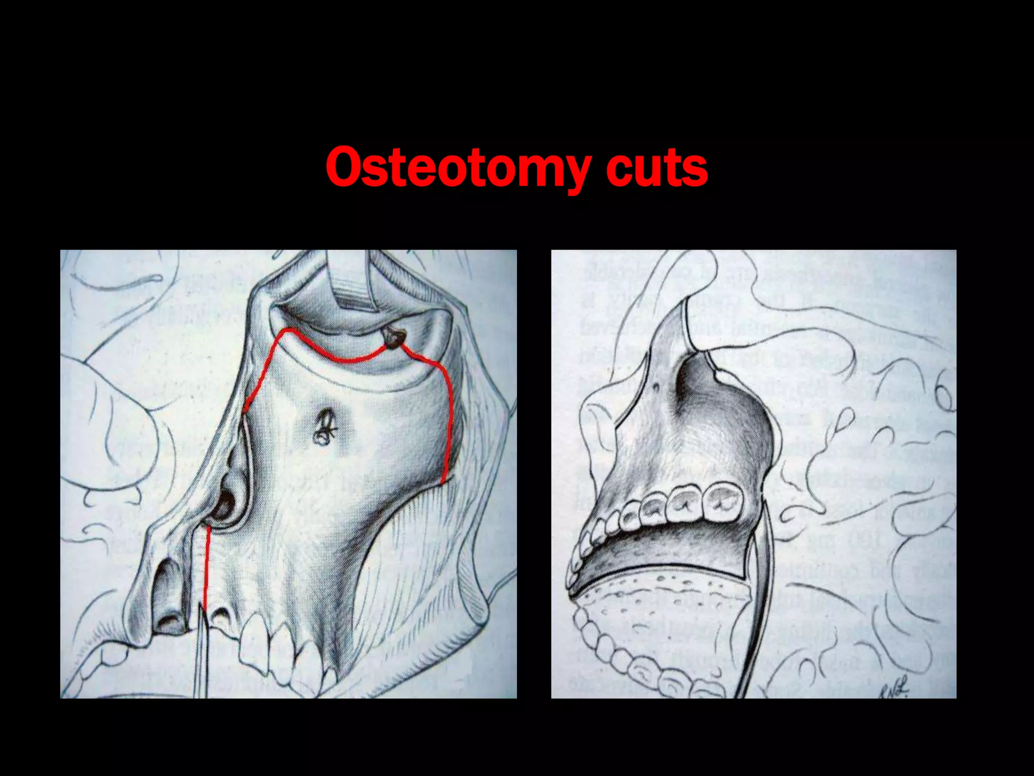 Neoplasms of nose and paranasal sinuses | PPT