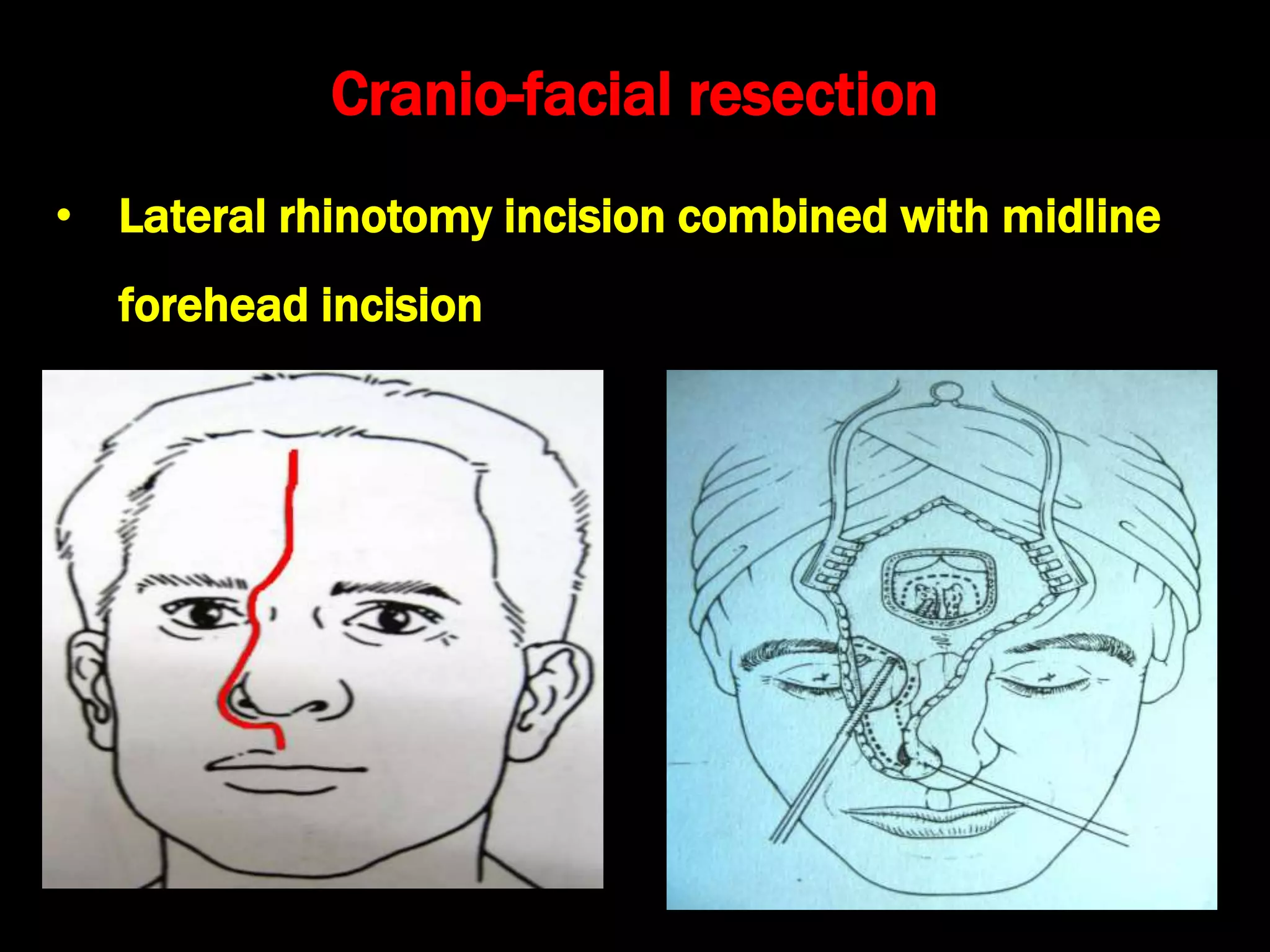 Neoplasms of nose and paranasal sinuses | PPT