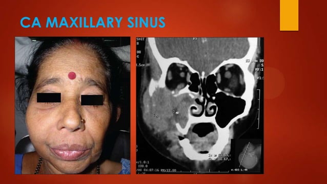 Neoplasms of paranasal sinuses.....by Navas shareef p p | PPTX | Ear ...
