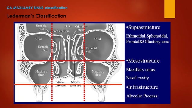 Neoplasms of paranasal sinuses.....by Navas shareef p p | PPTX | Ear ...