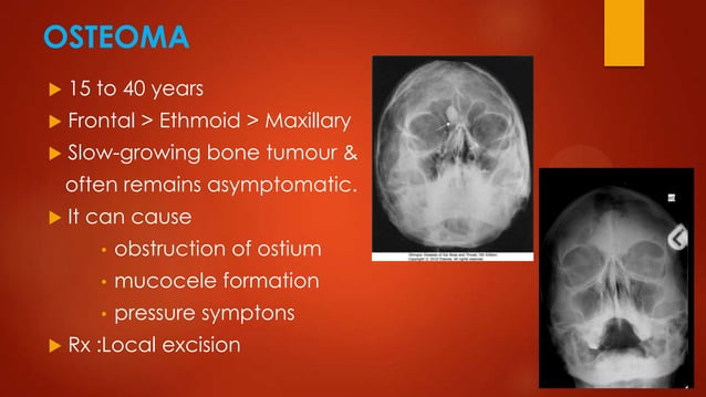 Neoplasms of paranasal sinuses.....by Navas shareef p p | PPTX | Ear ...