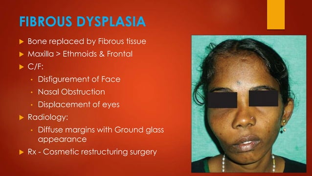 Neoplasms of paranasal sinuses.....by Navas shareef p p | PPTX | Ear ...