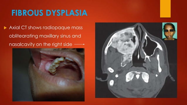 Neoplasms of paranasal sinuses.....by Navas shareef p p | PPTX | Ear ...
