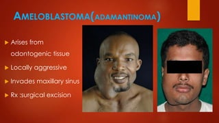 Neoplasms of paranasal sinuses.....by Navas shareef p p | PPTX