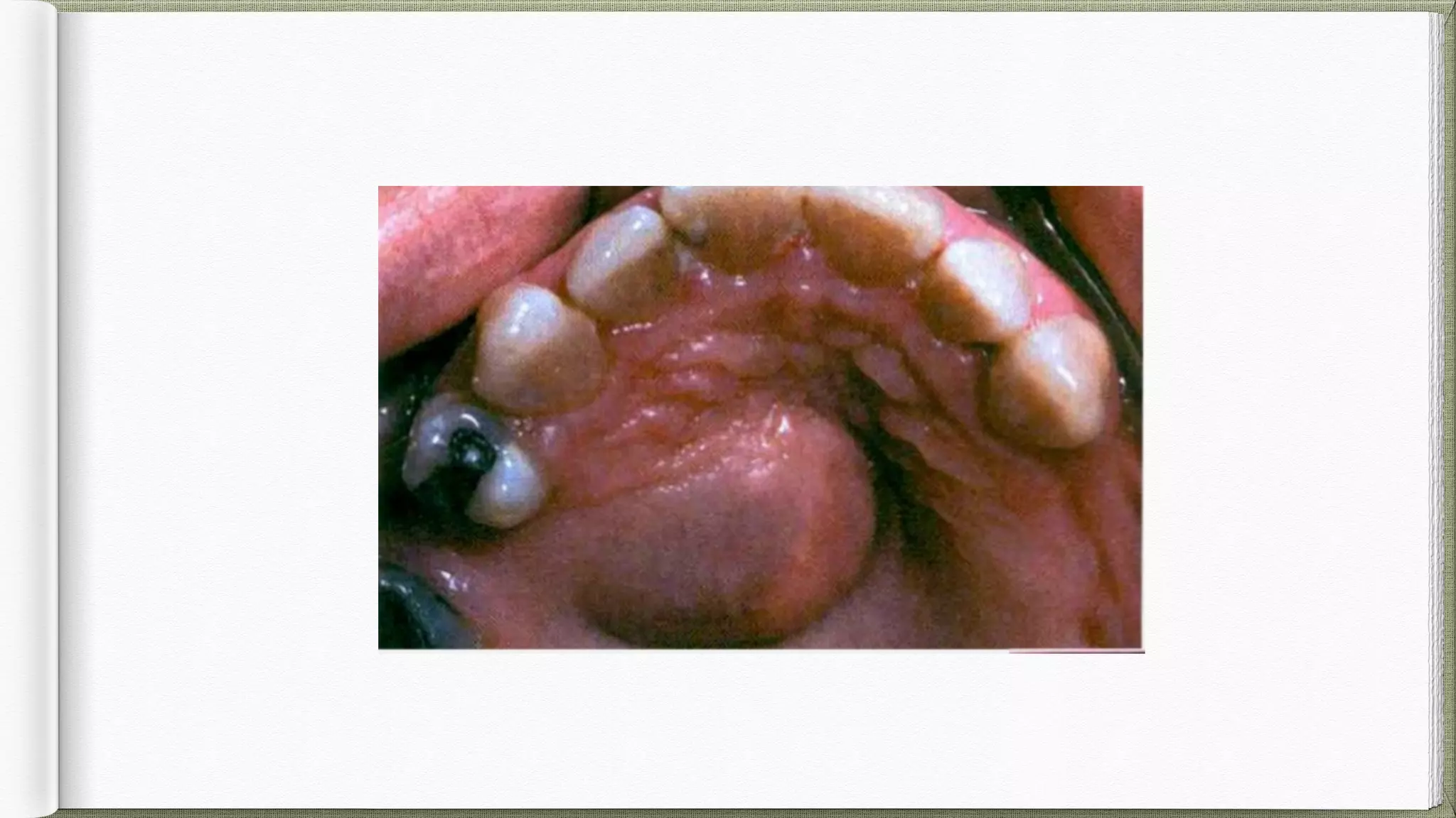 Neoplasms of Salivary Glands | PDF
