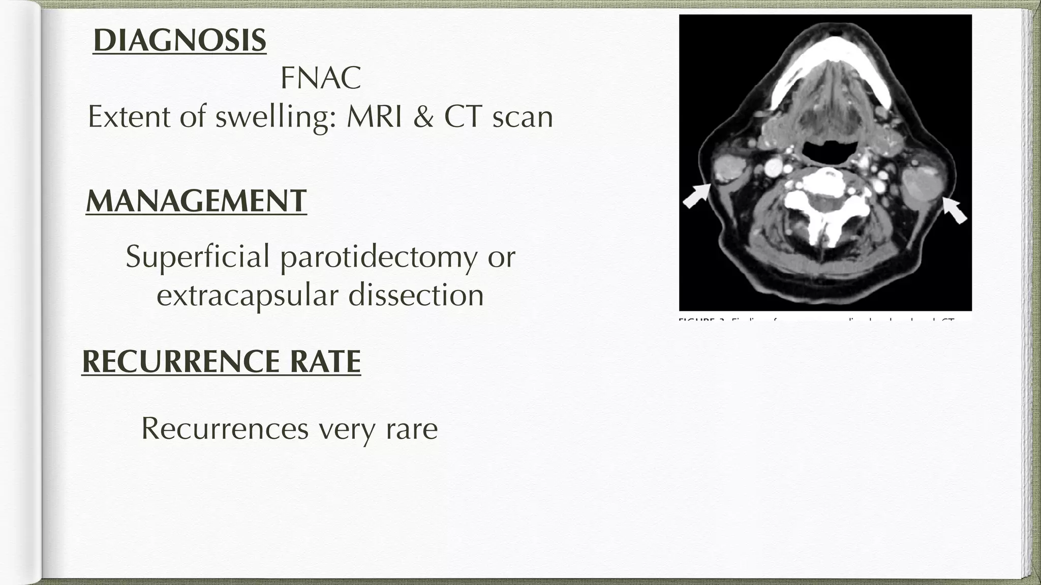 Neoplasms of Salivary Glands | PDF