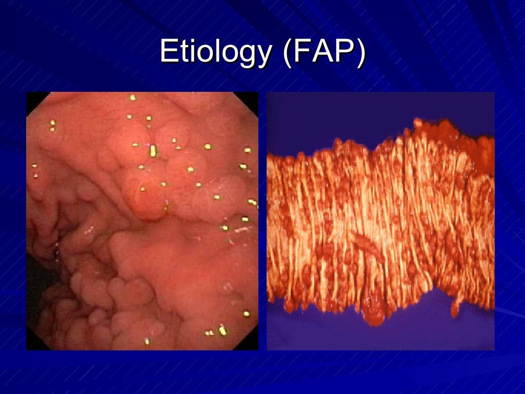 Neoplastic Colonic Polyp