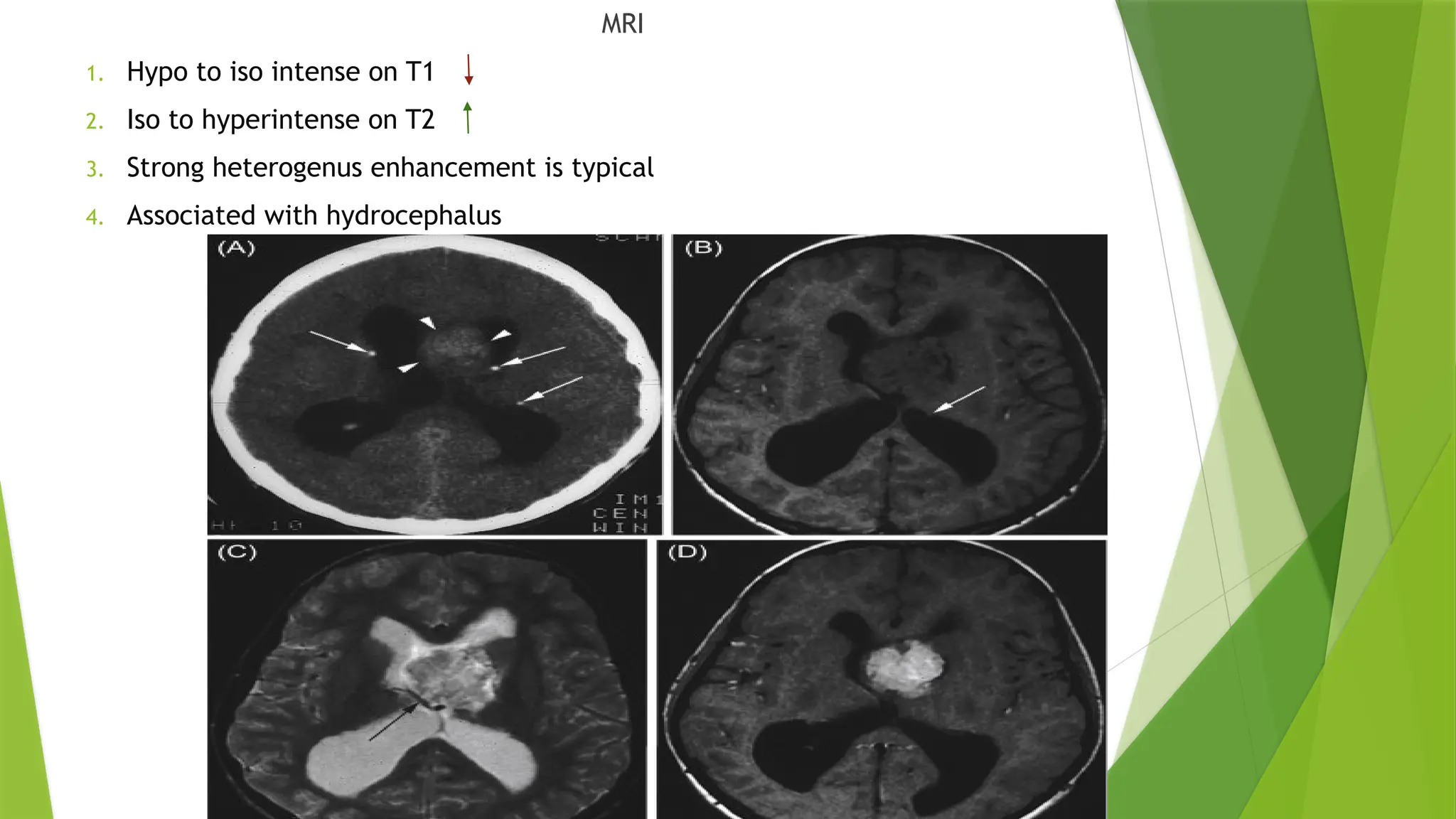 Neoplastic brain tumors in children.pptx