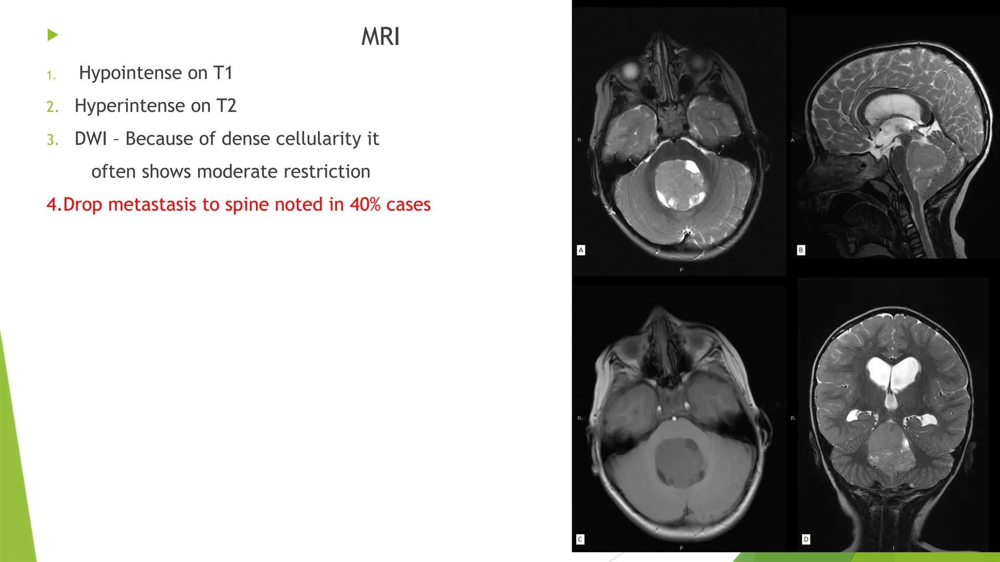 Neoplastic brain tumors in children.pptx