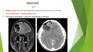 Neoplastic brain tumors in children.pptx