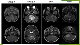 Neoplastic brain tumors in children.pptx
