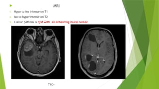 Neoplastic brain tumors in children.pptx