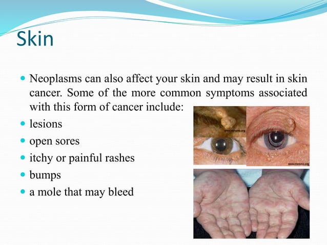 Neoplastic disease | PPTX