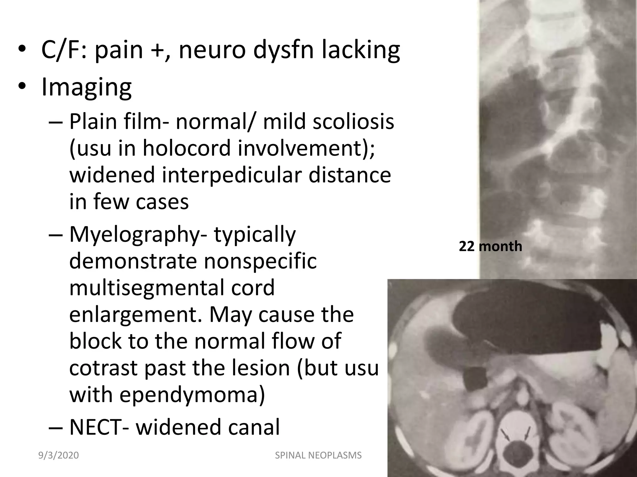 Neoplastic disorders of spinal cord | PPTX
