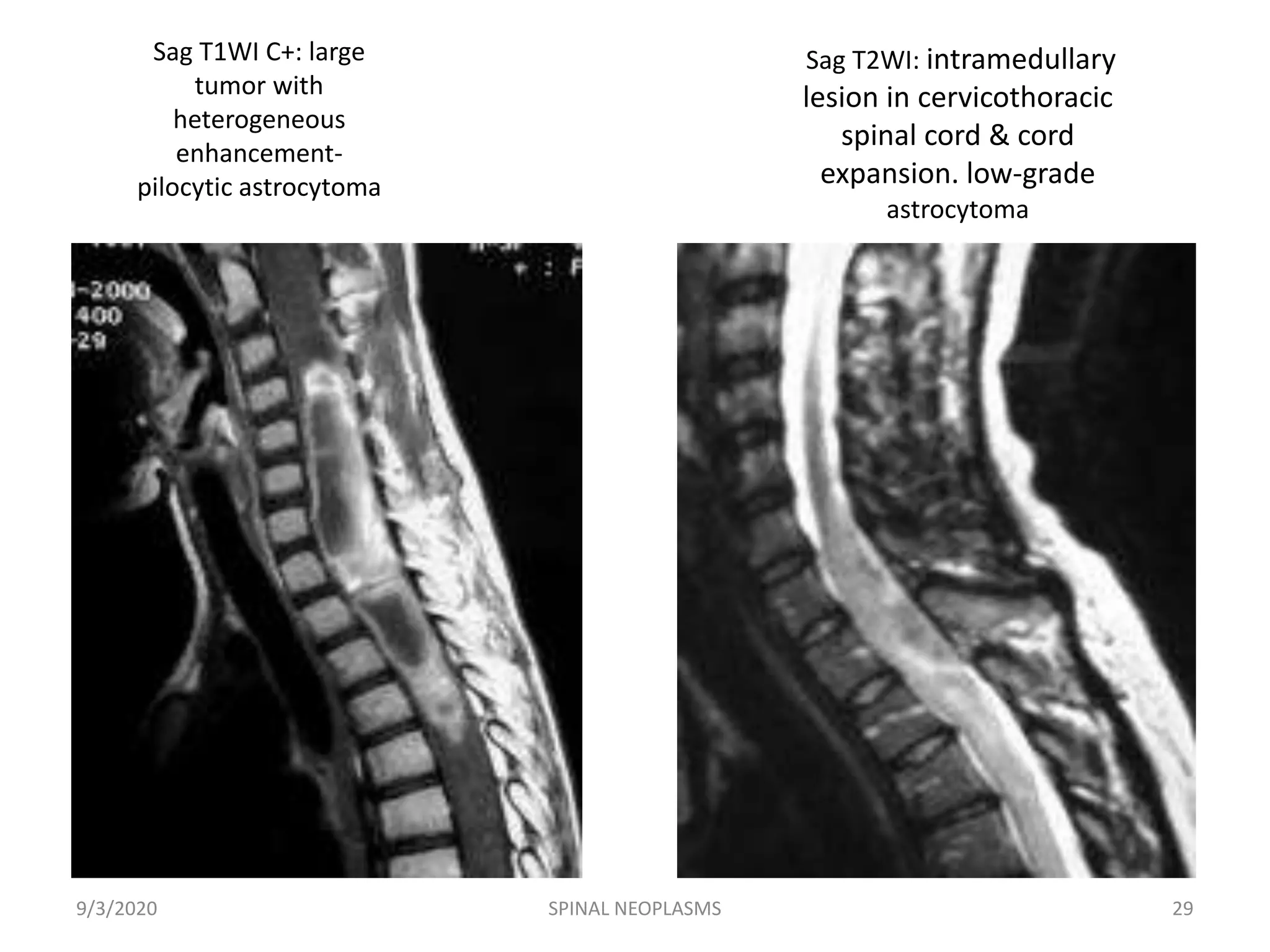 Neoplastic disorders of spinal cord | PPTX