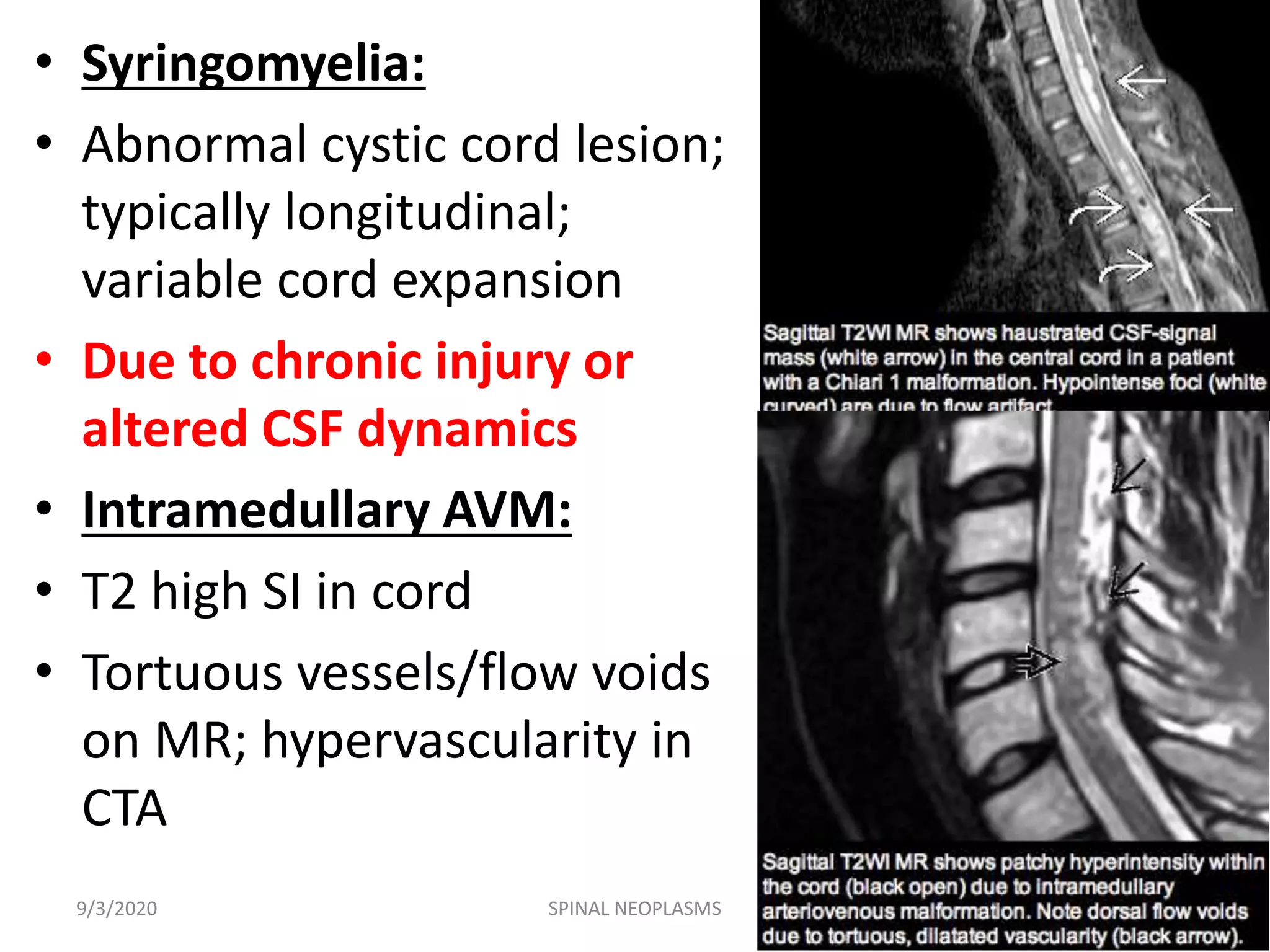 Neoplastic disorders of spinal cord | PPTX