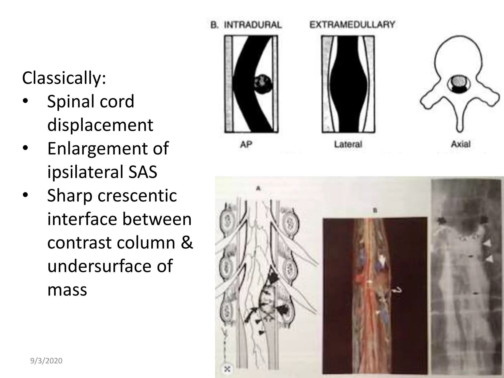 Neoplastic disorders of spinal cord | PPTX