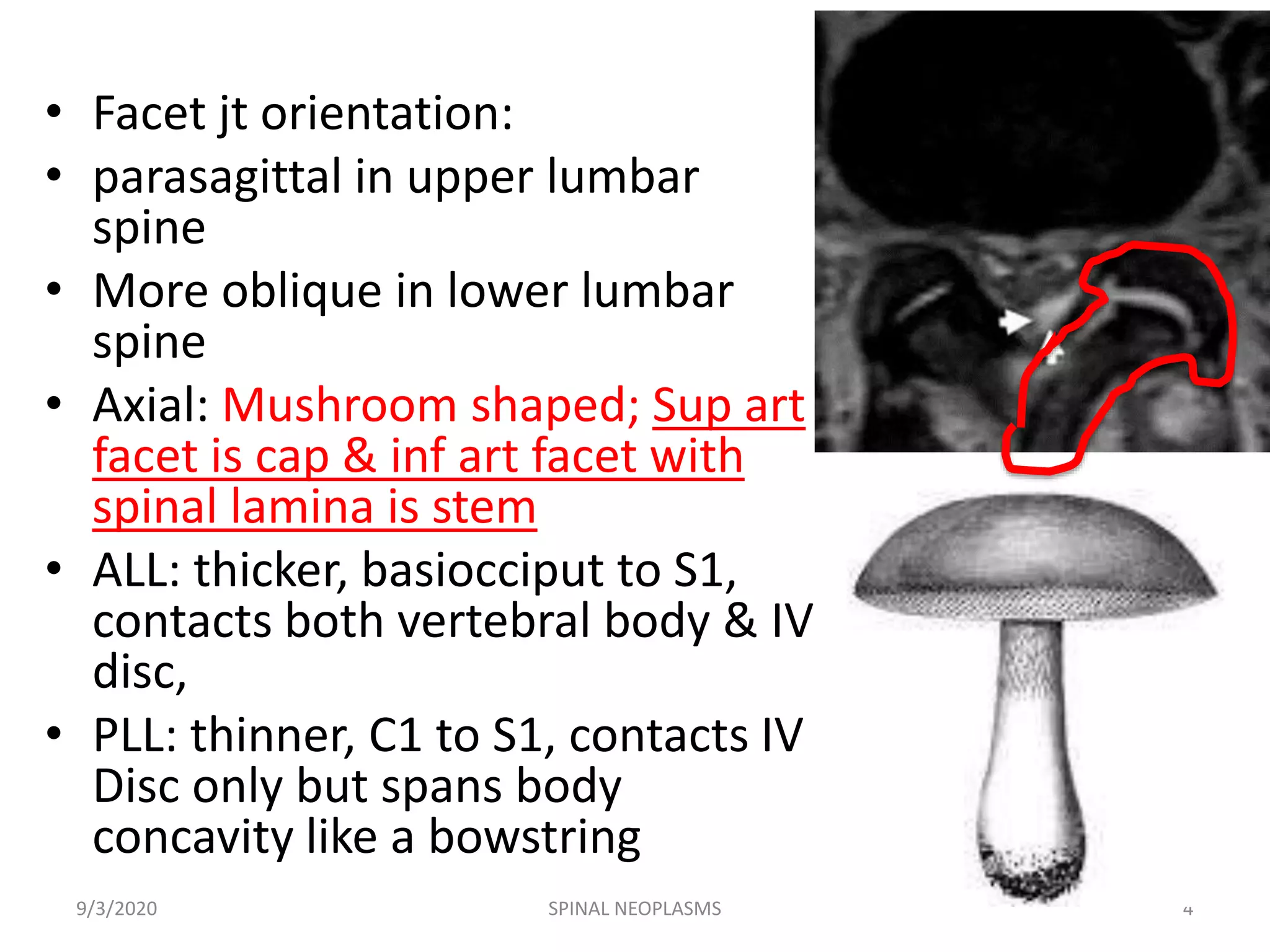 Neoplastic disorders of spinal cord | PPTX