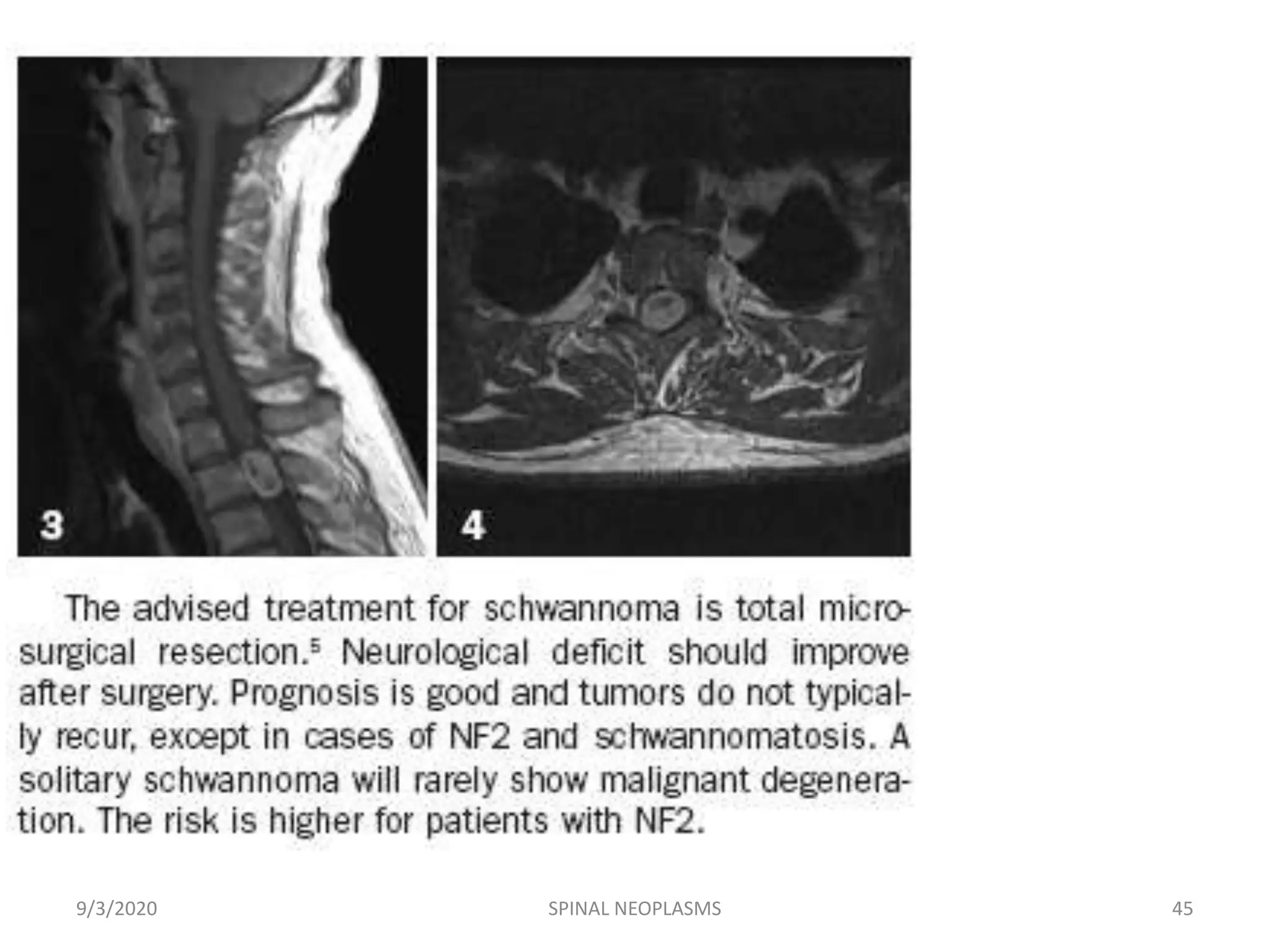 Neoplastic disorders of spinal cord | PPTX