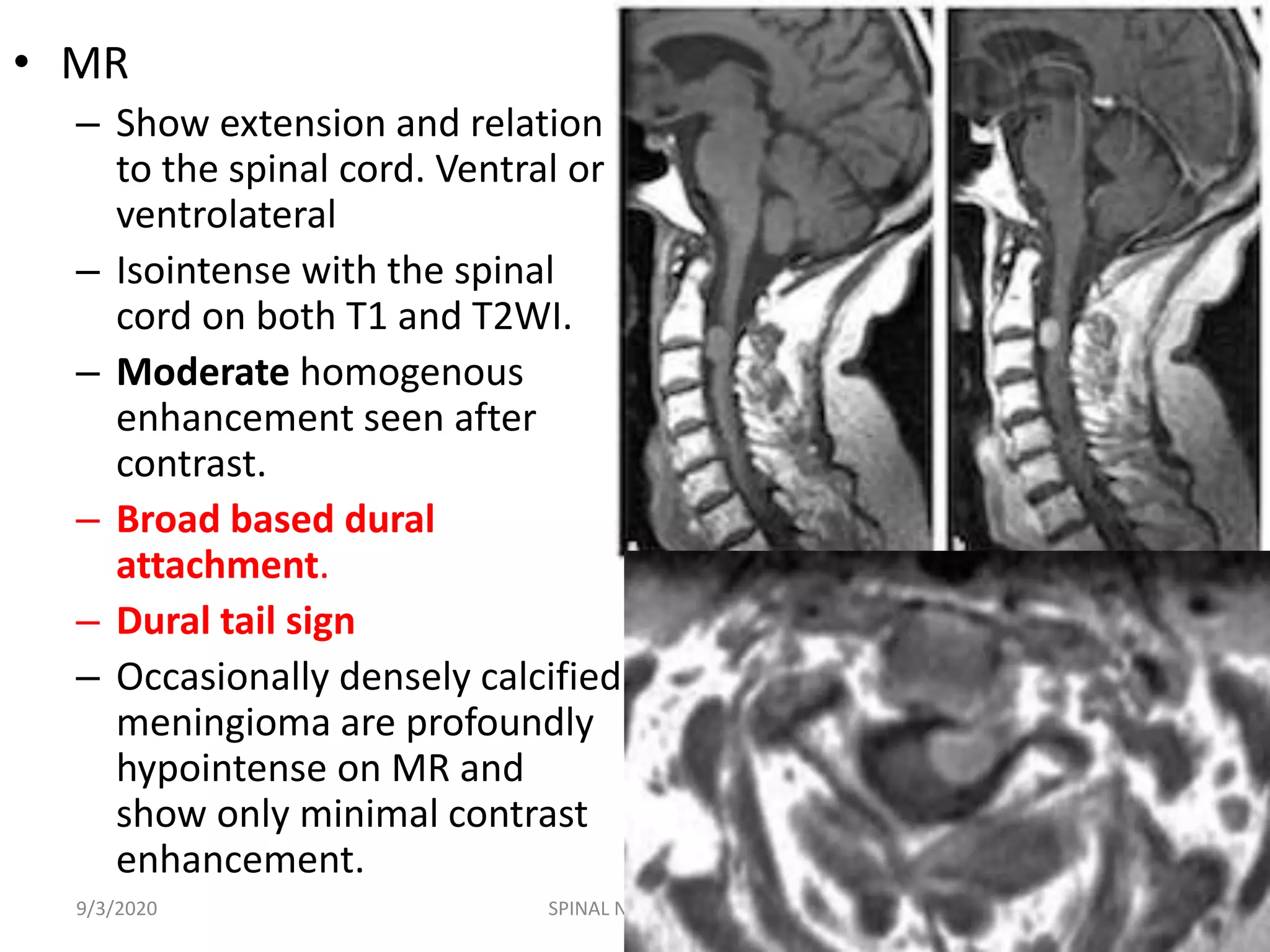 Neoplastic disorders of spinal cord | PPTX
