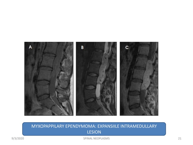 Neoplastic disorders of spinal cord | PPTX