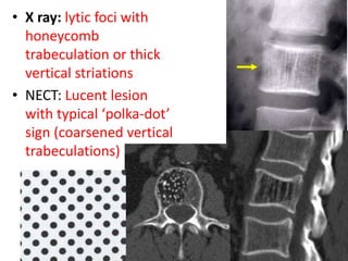 Neoplastic disorders of spinal cord | PPTX