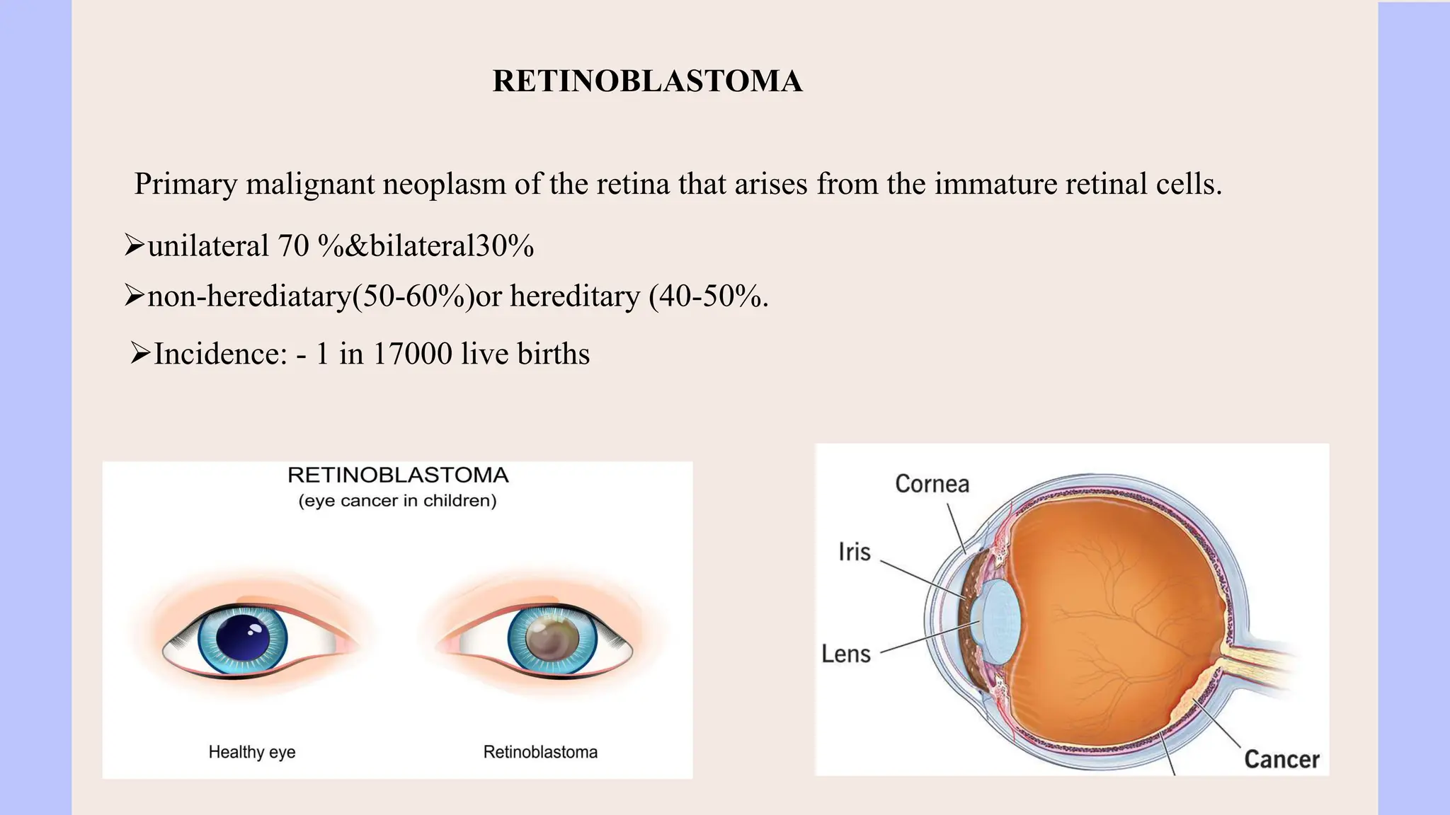 ocular tumors among pediatric patient . | PPTX
