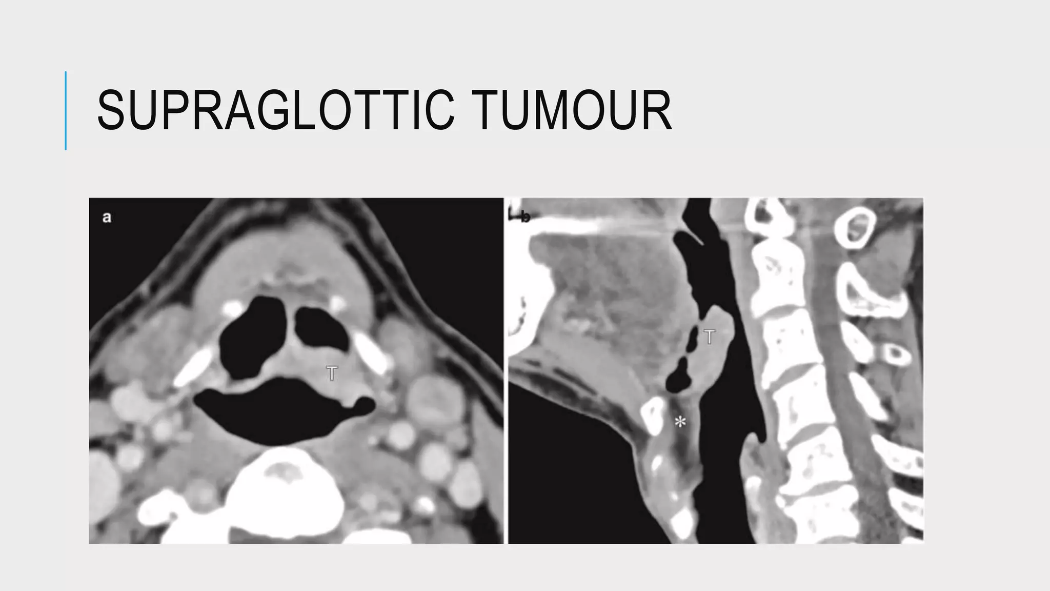 Malignant lesions of larynx | PPTX