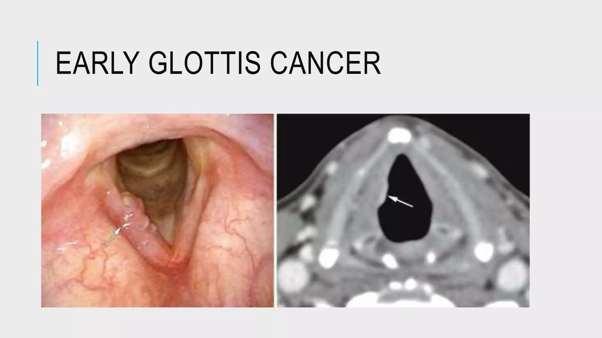 Malignant lesions of larynx | PPTX
