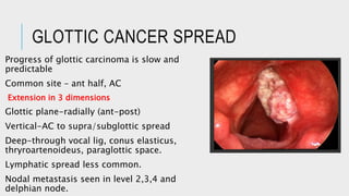 Malignant lesions of larynx | PPTX