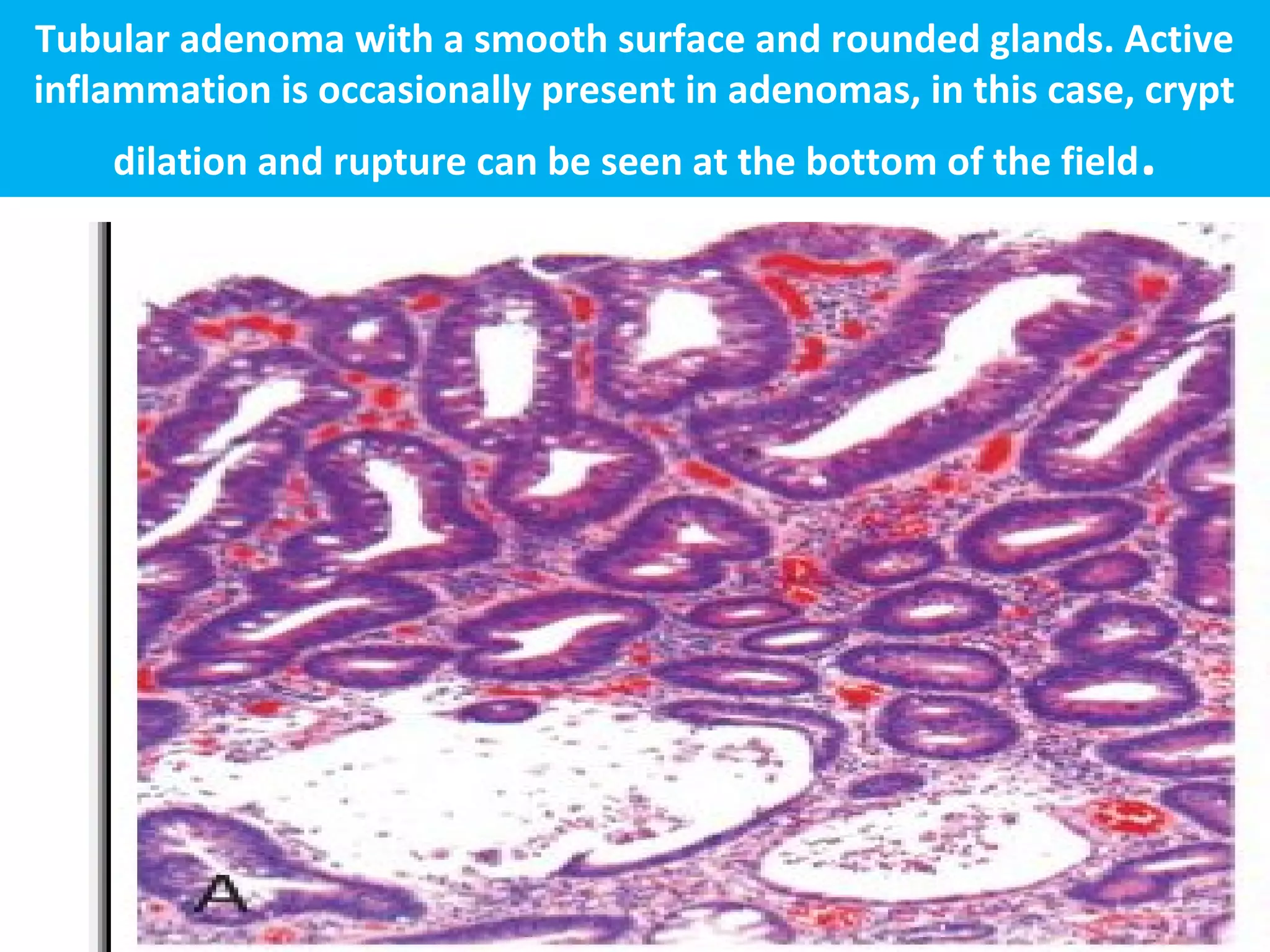 Neoplastic Colonic polyps- Colonic Adenoma; Familial Syndromes | PPT